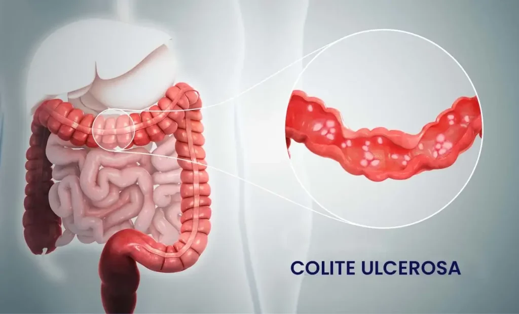 Colite: Diagnosi e Trattamento - Biomedic Center