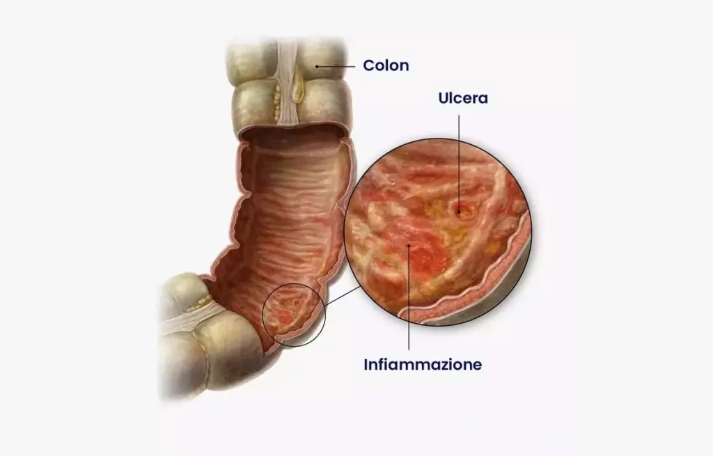 Colite: Diagnosi e Trattamento - Biomedic Center
