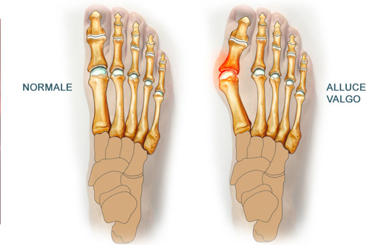 Alluce valgo (cipolla) sintomi, cause e trattamento