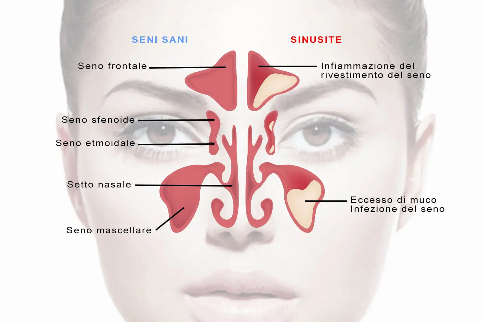 Sinusite - Biomedic Center